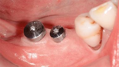 Rehabilitation of a Mandibular Distal Extension Situation in a 89-year ...