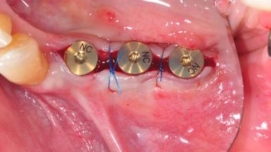 Placement of Narrow Diameter Two-Piece Implants with Simultaneous GBR ...