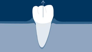 Minimally Traumatic Extraction Techniques - Assessments - Academy - ITI