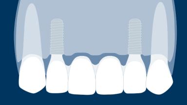 Implant Configurations for Fixed Dental Prostheses - Assessments ...