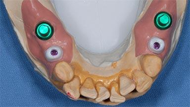 Replacement of Multiple Teeth in a Partially Dentate Posterior Mandible ...