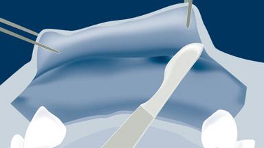 Periosteal Releasing Incision (PRI) - Learning Modules - Academy - ITI