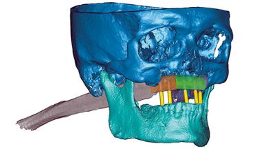 Rehabilitating a Maxillofacial Defect with Transplanted Free ...