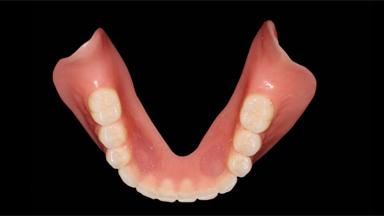 Maxillary Complete Denture and Mandibular Overdenture on Two Implants ...