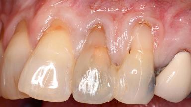 Early Implant Placement, Contour Augmentation, and Autologous ...