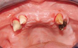 Immediate Implant Placement with Simultaneous Bone and Soft Tissue ...