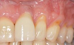 Soft-Tissue Volume Augmentation Using a Connective-Tissue Graft ...