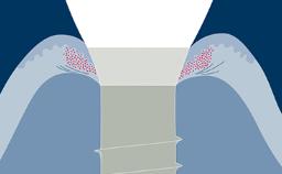 Implant Designs and Characteristics - Learning Modules - ITI