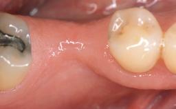 Periodontal Plastic Surgery and Prosthetic Procedures to Treat Peri ...