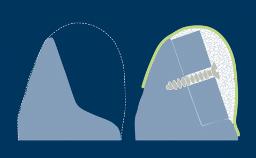 Minimally Traumatic Extraction Techniques - Learning Modules - ITI