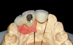 Replacement of Failing Hydroxyapatite-Coated Cylinder-Type Implants ...