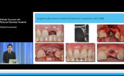 Minimally Invasive Extraction Techniques - Congress Lectures - ITI