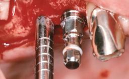 Immediate Implant Placement with Simultaneous Bone and Soft Tissue Augmentation Using Bone and ...