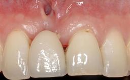 Periodontal Plastic Surgery and Prosthetic Procedures to Treat Peri ...