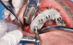 Immediate Implant Placement with Simultaneous Bone and Soft Tissue ...