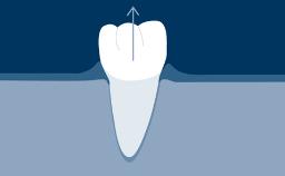 Surgical Complications and Management - Assessments - ITI