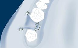 Periosteal Releasing Incision (PRI) - Assessments - Academy - ITI