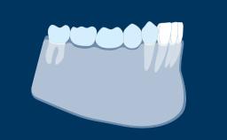 Minimally Traumatic Extraction Techniques - Learning Modules - ITI