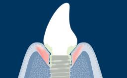 Healing of the Extraction Socket - Learning Modules - ITI