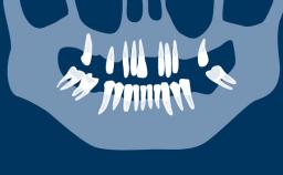 Minimally Traumatic Extraction Techniques - Learning Modules - ITI