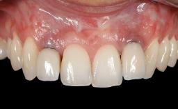 Soft-Tissue Volume Augmentation Using a Connective-Tissue Graft ...