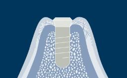 Implant Designs and Characteristics - Assessments - ITI